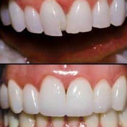 Composite Dental Filling Procedure New York | Esthetix Dental Spa