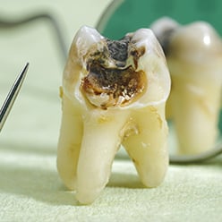 Composite Dental Filling Procedure New York | Esthetix Dental Spa