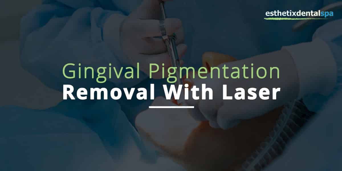Gingival Pigmentation | Esthetix Dental Spa | Dentist in NYC