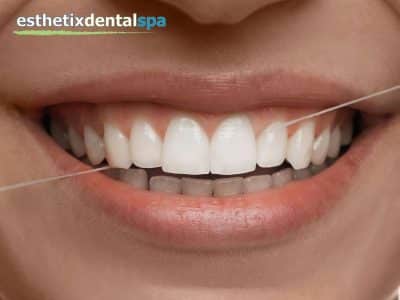 How Do I Keep My Invisalign Trays From Turning Yellow?